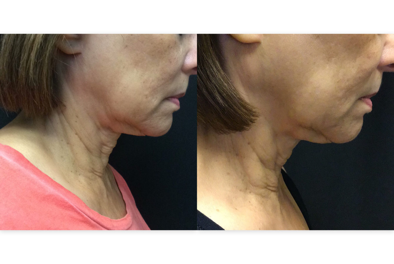 Microneedling - Before & After Pictures of Neck, Wrinkles and More