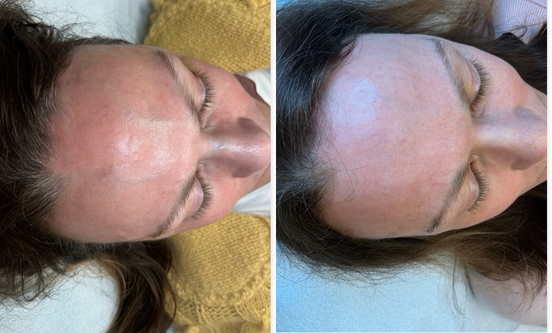 Face Vein Treatment in Issaquah and Bellevue - VIVAA Seattle, WA